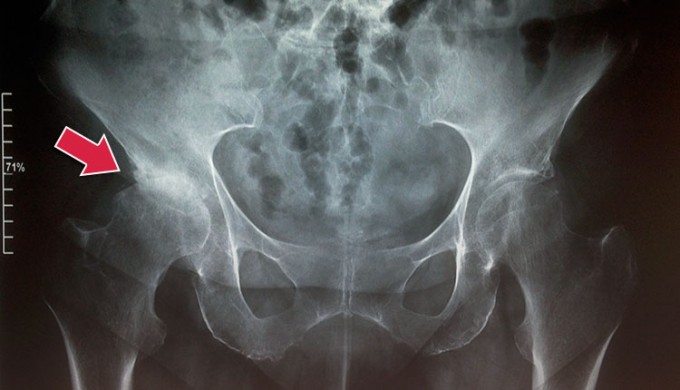 Prothèse totale de hanche - Chirurgie Orthopédique Versailles